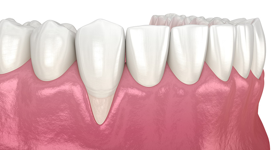 Greffe de gencive - Dentistes de la Cité